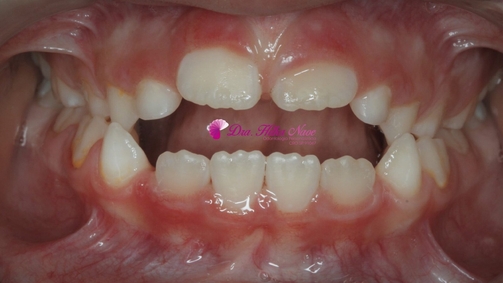 Mordida Aberta em crianças – Instituto Naoe